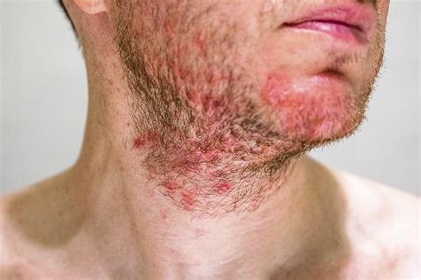 Foliculite saiba o que é as causas e as áreas mais afetadas