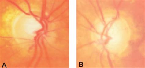 Same Subject A Early Glaucoma Right Eye Temporal Pallor Increased Download Scientific