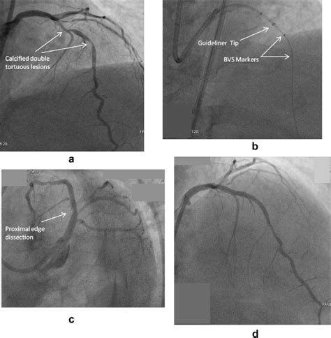 E Case 2 A Ap Cranial View Showing Lad D1 Bifurcation Lesion B Download Scientific
