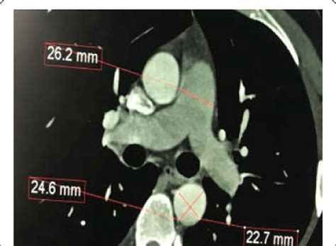 ECG Gated Cardiac Computed Tomography Axial View Of The Descending