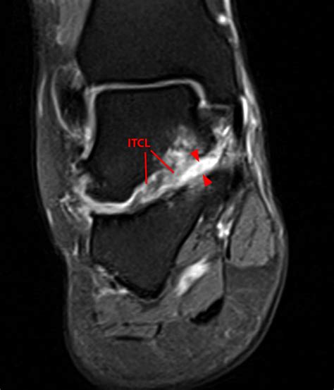 Sinus Tarsi Fat Pad