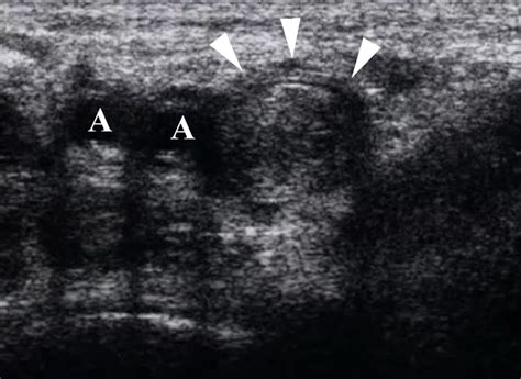 Dvt Images Emergency Ultrasonography