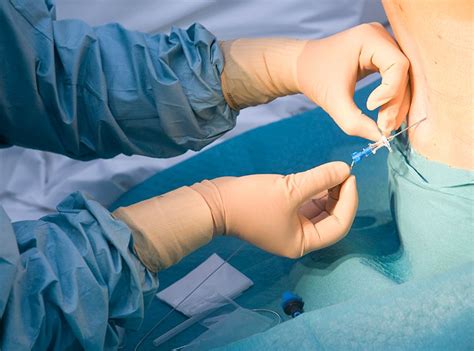 The Pros And Cons Of Getting An Epidural Self