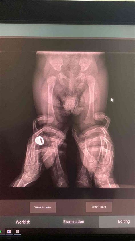 عمر خمس شهور عملت فحص خلع الولادة طلع عندها عدم اكتمال نمو الطبي