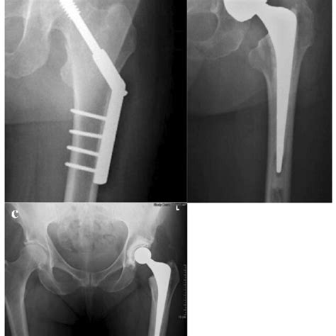 Femoral Neck Intra Capsular Fracture Of The Left Hip Download