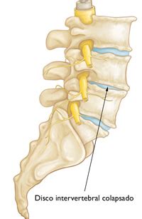 Dolor Lumbar TMR Buenos Aires