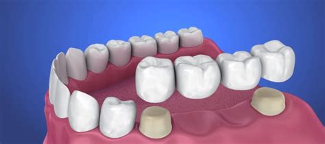 Wisdom Teeth Recovery Guide Tips For Safe Fast Healing