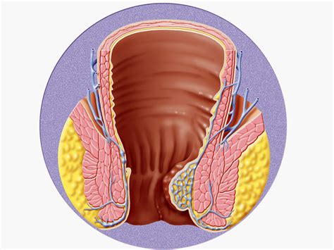 6 Facteurs Qui Augmentent Le Risque Dhémorroïdes One Media