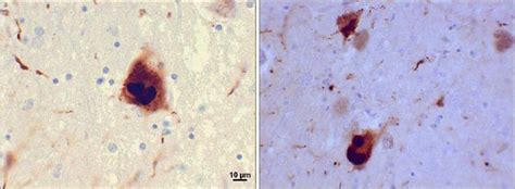 Researchers Find Inhibiting One Protein Destroys Toxic Clumps Seen In