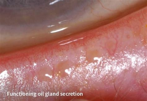 Tearcare Dry Eye Treatment Hauser Ross Eye Institute
