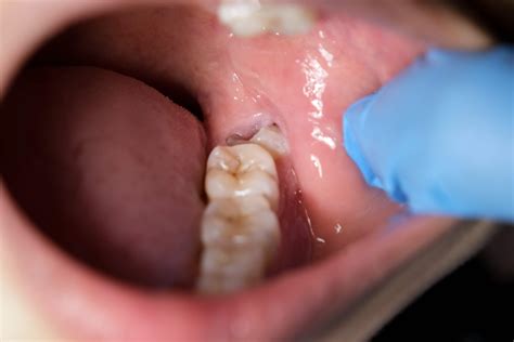 Wisdom Teeth Essential Living For Nw Essential Oils For Natural