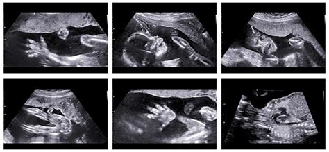 What Is Anomaly Scan During Pregnancy And Why Is It Done