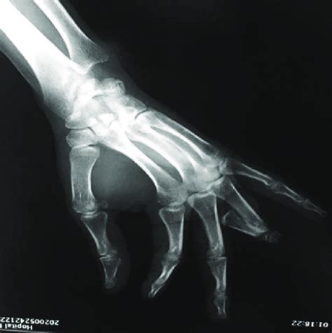 Hand X Ray Showing Dislocation Of The Pip Joint Of The Fourth Finger
