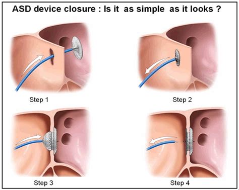 Device Closure Of Asd Vsd Pda Dr Tejas V Patel Cardiologist