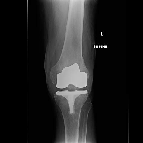 Todd Morrison Md Hip And Knee Replacement Fairfield Connecticut Facebook