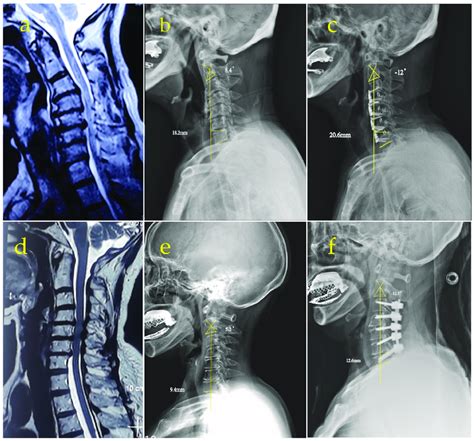 A Preoperative Mri Showing Cervical Spinal Stenosis And Myelopathy