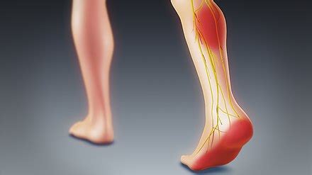 Sciatica Wikipedia