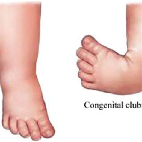 Ctev Congenital Talipes Equion Varus 2 Download Scientific Diagram