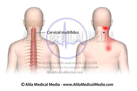Multifidus Cervical