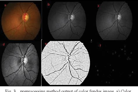 Figure 3 From Automatic Detection And Classification Of Microaneurysms