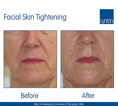 Skin Tightening And Skin Lifting · The Lynton Clinic Cheshire