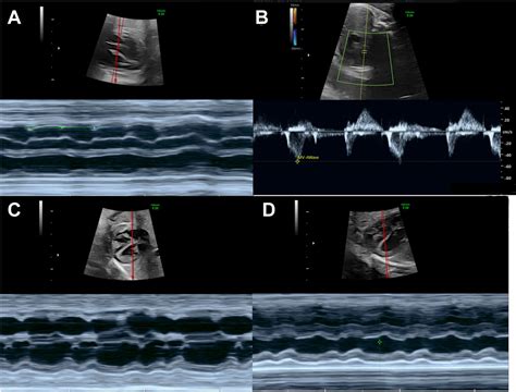 Novel Phenotypic Effects Of A Rare Scn5a C 2482c T Mutation Jacc Case Reports