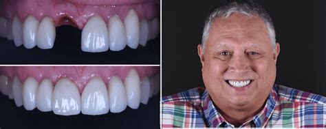 Tucson Dental Implants Skyline Dental