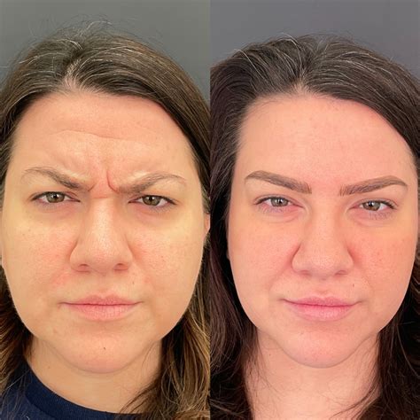 Daxxify Skinaesthetica