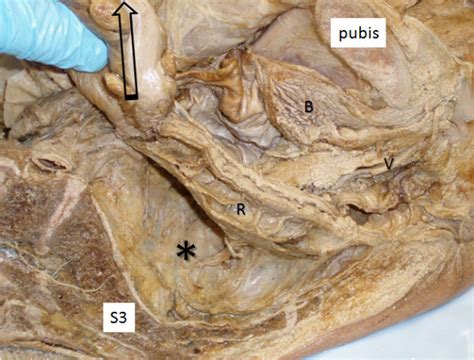Anterior Reflection Of The Rectosigmoid Junction In The Female The Download Scientific Diagram