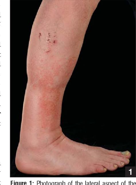 Figure 1 From Herpes Zoster Virus An Unusual But Potentially Treatable
