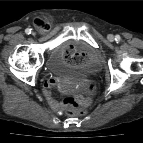 Oedematous And Infective Appendix With Necrotic Tip Seen Within The