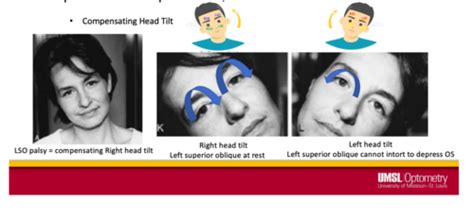 Ocular Motor Disorders Flashcards Quizlet