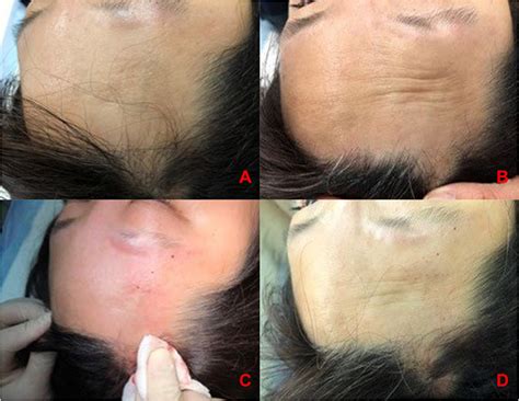 Linear Morphea
