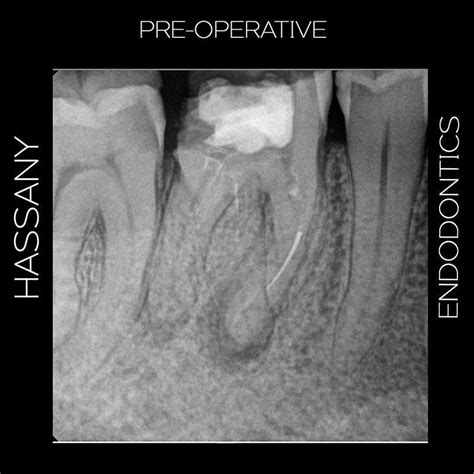 Root Canal Therapy Tysons Corner Falls Church Vienna Va