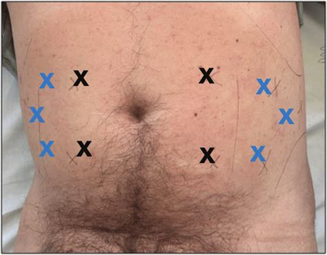The Xs Mark The Infiltrations Sites Of The Botulin Toxin Type A Tba