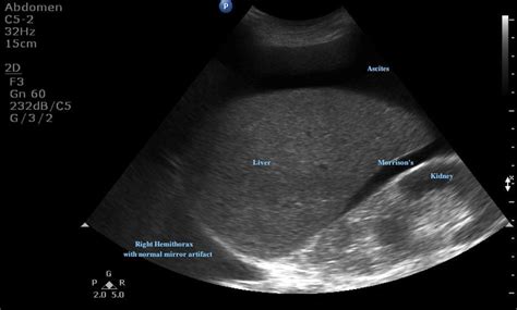 Pin On Abd 200 Mod 3 Ultrasound