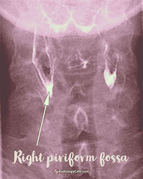 Correct Answer Right Piriform Fossa Please Remember To Also Write The