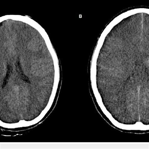 Computed Tomography Ct Scans On Admission And On The Last Day Of