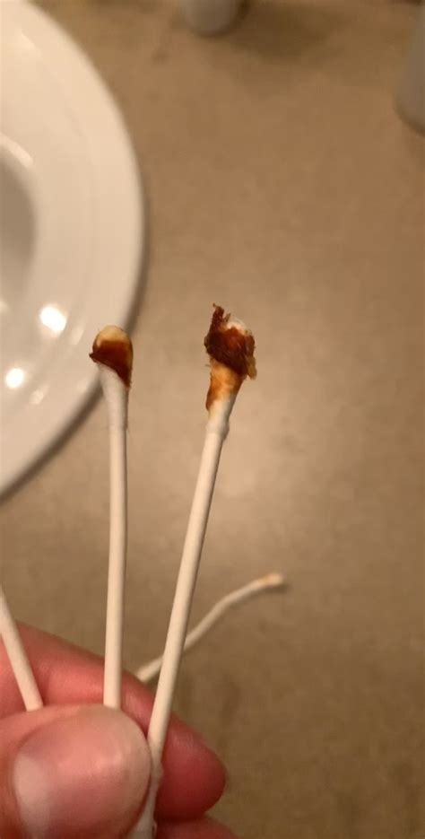 Damaged My Eardrum About Two Years Ago For The Last Few Months I Haven