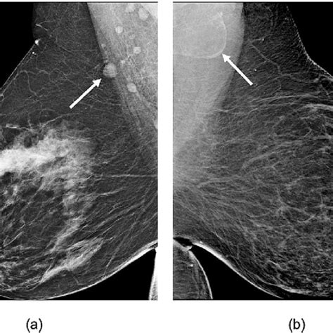 Variable Axillary Lymph Node Size And Morphology On Breast Mri 65 Yo