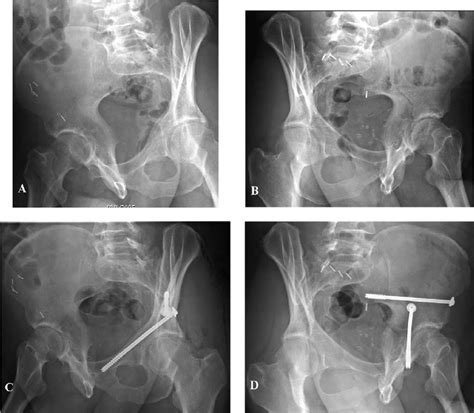 A B Judet Oblique Radiographs Depicting A Minimally Displaced
