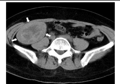 Figure 1 From A 52 Year Old Woman With A Palpable Abdominal Mass