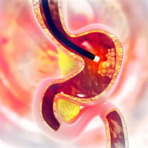 Early Detection Of Gastric Cancer Gastroclear