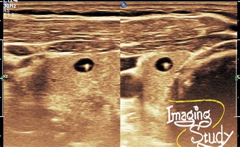 Case 14 Colloid Nodule Of Thyroid Gland ~ Imaging Study