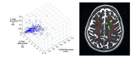 Brain Mri Lucia Ballerini