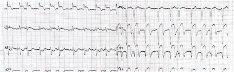 Coronary Angiogram In Second Pci A Corangiography Before Stenting