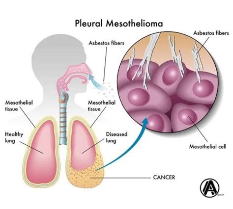 Asbestos Related Cancer Cases In Women Are Spiking In The Uk — Asbestos
