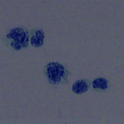 Cytology Showing Many Atypical Lymphocytes In The Cerebrospinal Fluid