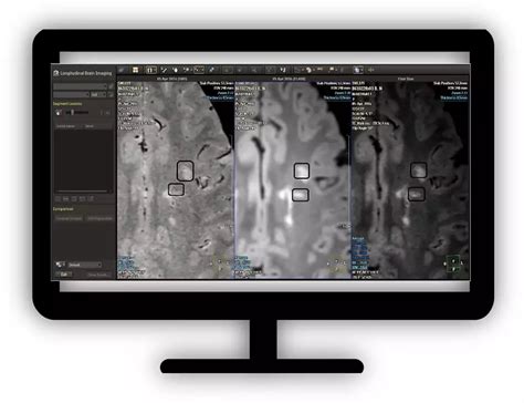 Philips Mr Longitudinal Brain Analysis Lobi