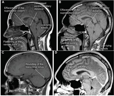 什么是自发性低颅压？ 知乎